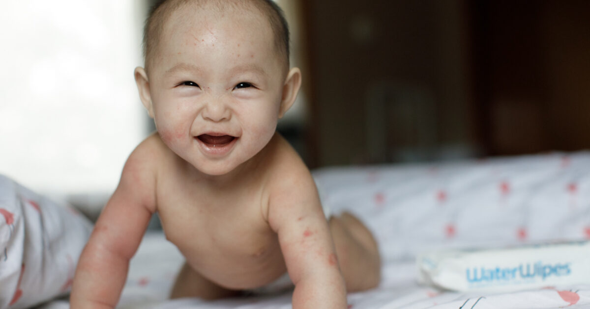 Eczeem versus psoriasis: wat is het verschil en hoe… | WaterWipes NL