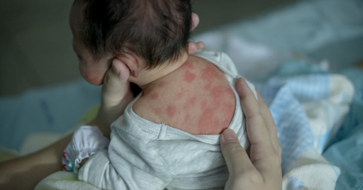 Baby Skin Conditions | Baby Dry Skin, Cradle Cap,… | WaterWipes